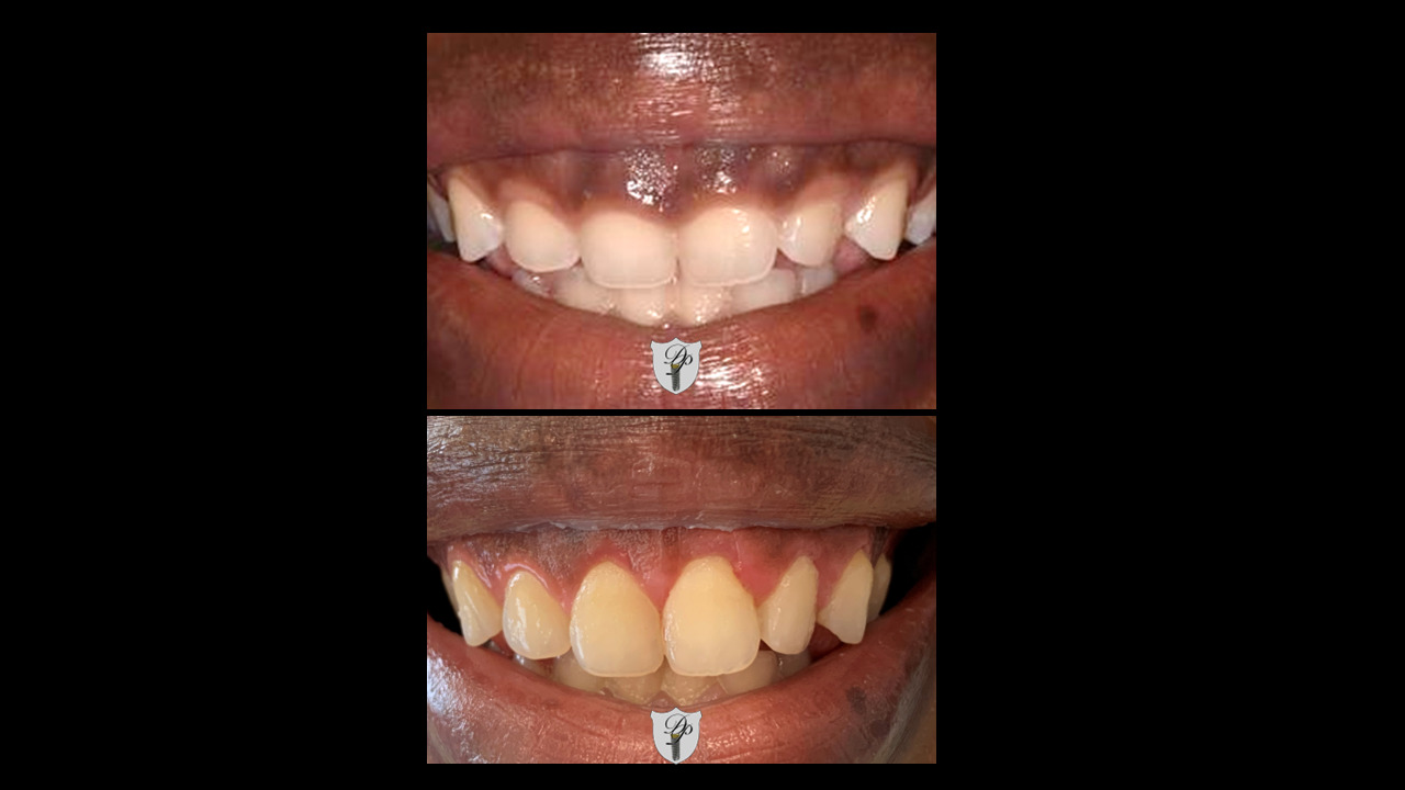 Affordable & Economical Dental Crown Lengthening Toronto | Davisville ...